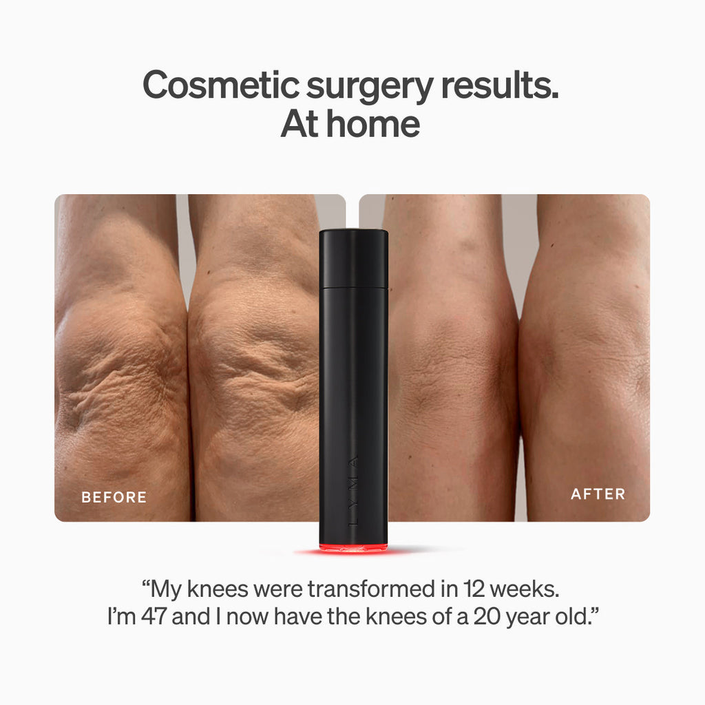 Shop the LYMA Laser – The Most Powerful At-Home Skincare Laser in US ...