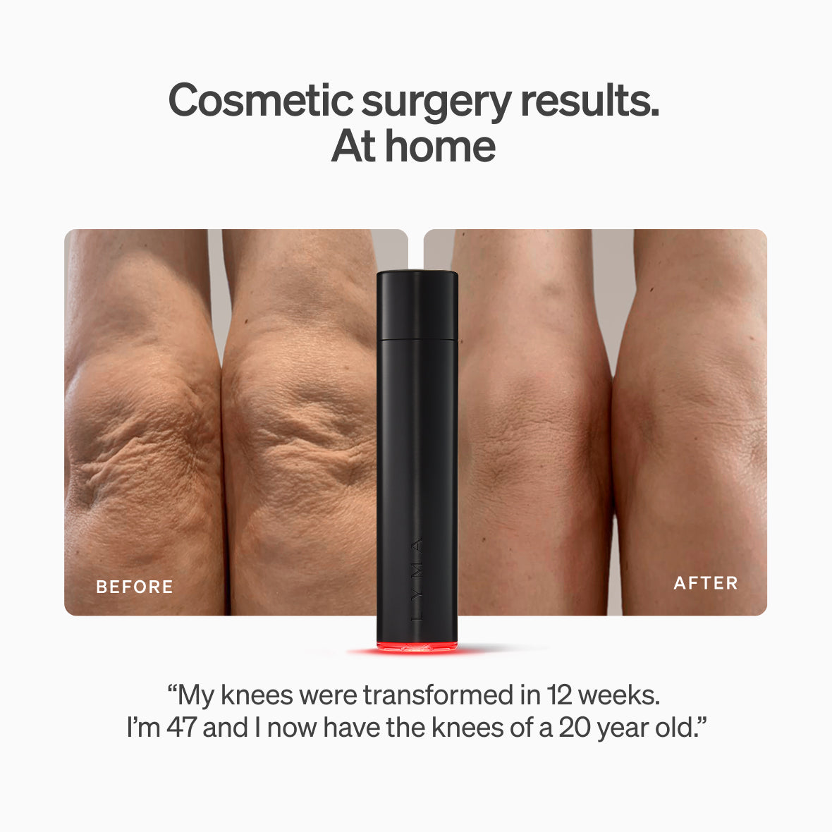 Shop the LYMA Laser – The Most Powerful At-Home Skincare Laser in US ...